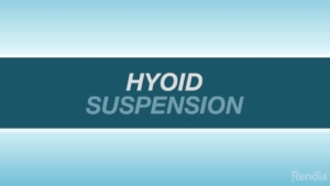 Hyoid Suspension: Overview - ENTJC